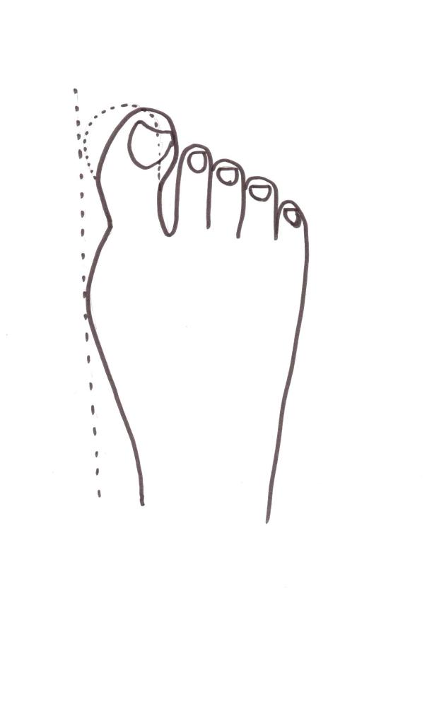 Vbočený palec - vše, co potřebujete vědět + nejnovější poznatky